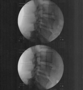 Epidural Injections - LA Orthopedic & Pain Center