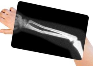 Malunion & Nonunion - LA Orthopedic & Pain Center