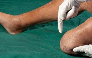 Phantom Limb Pain - LA Orthopedic & Pain Center