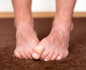 Turf Toe - LA Orthopedic & Pain Center